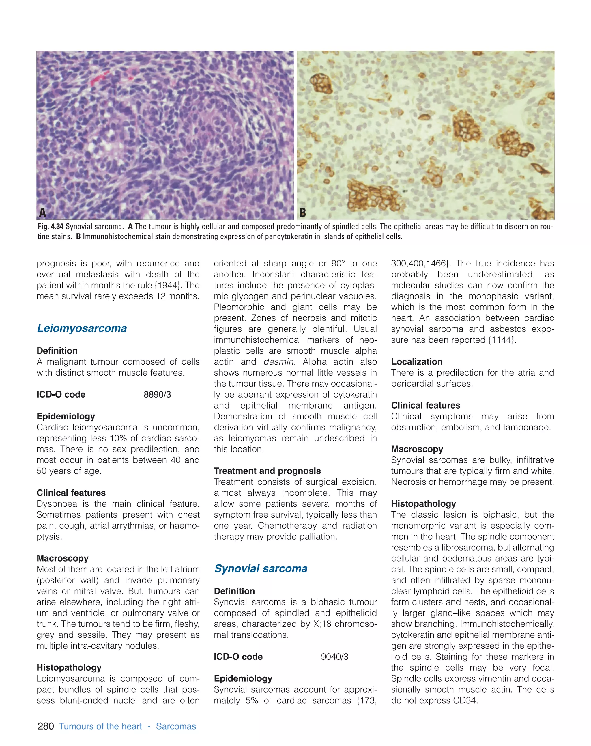 Tumours of the heart | PDF