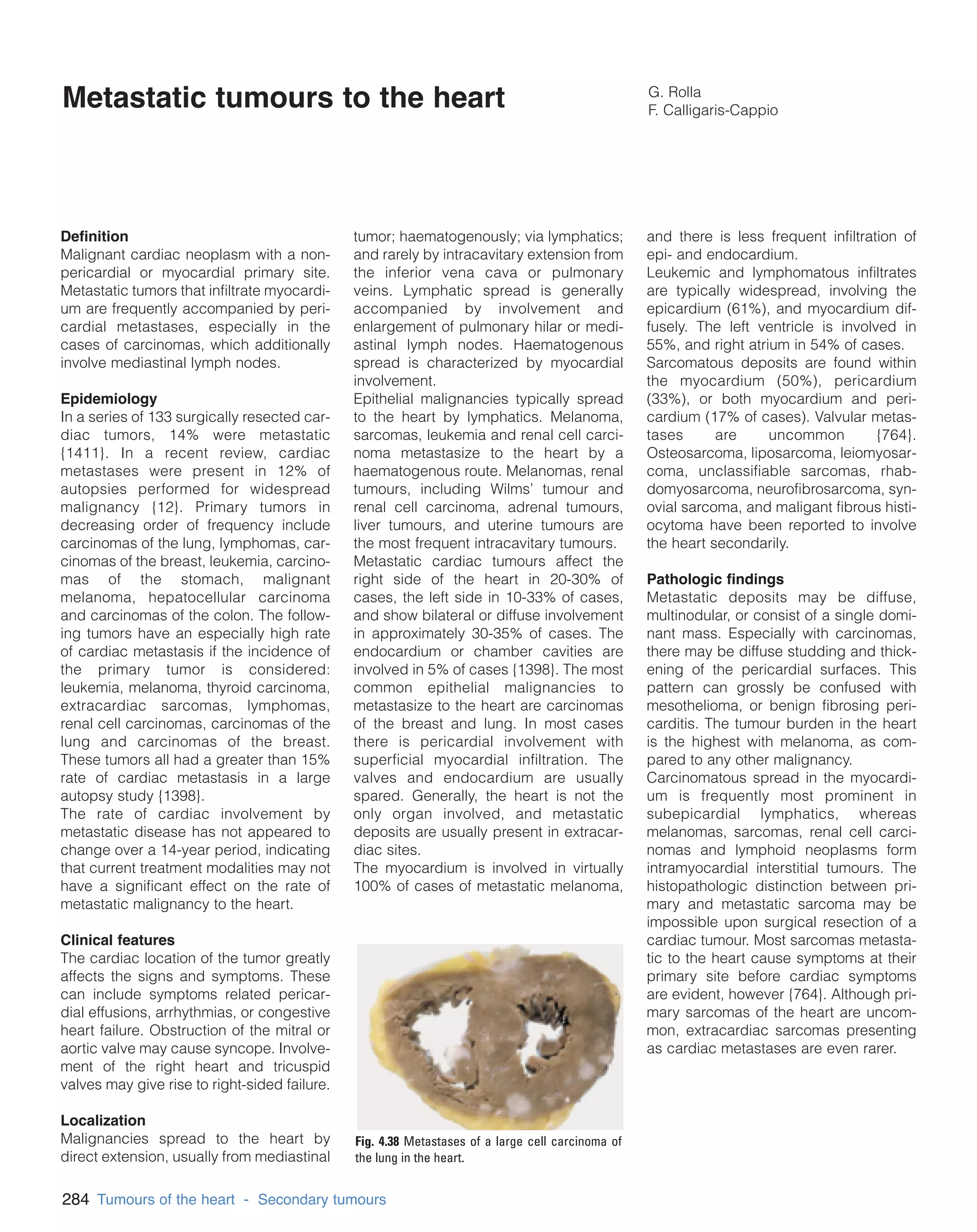 Tumours of the heart | PDF