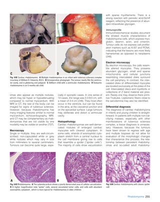 Tumours of the heart | PDF
