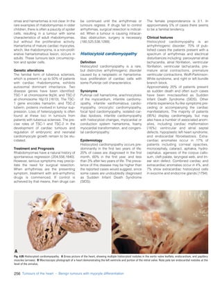 Tumours of the heart | PDF