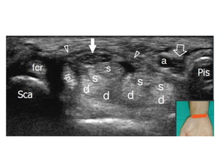 Ultrasound Guided Minimally Invasive Interventions for the Common ...
