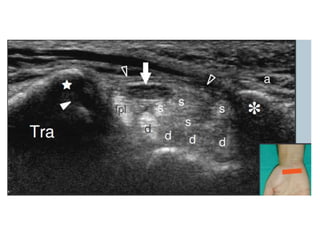 Ultrasound Guided Minimally Invasive Interventions for the Common ...