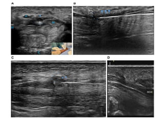 Ultrasound Guided Minimally Invasive Interventions for the Common ...