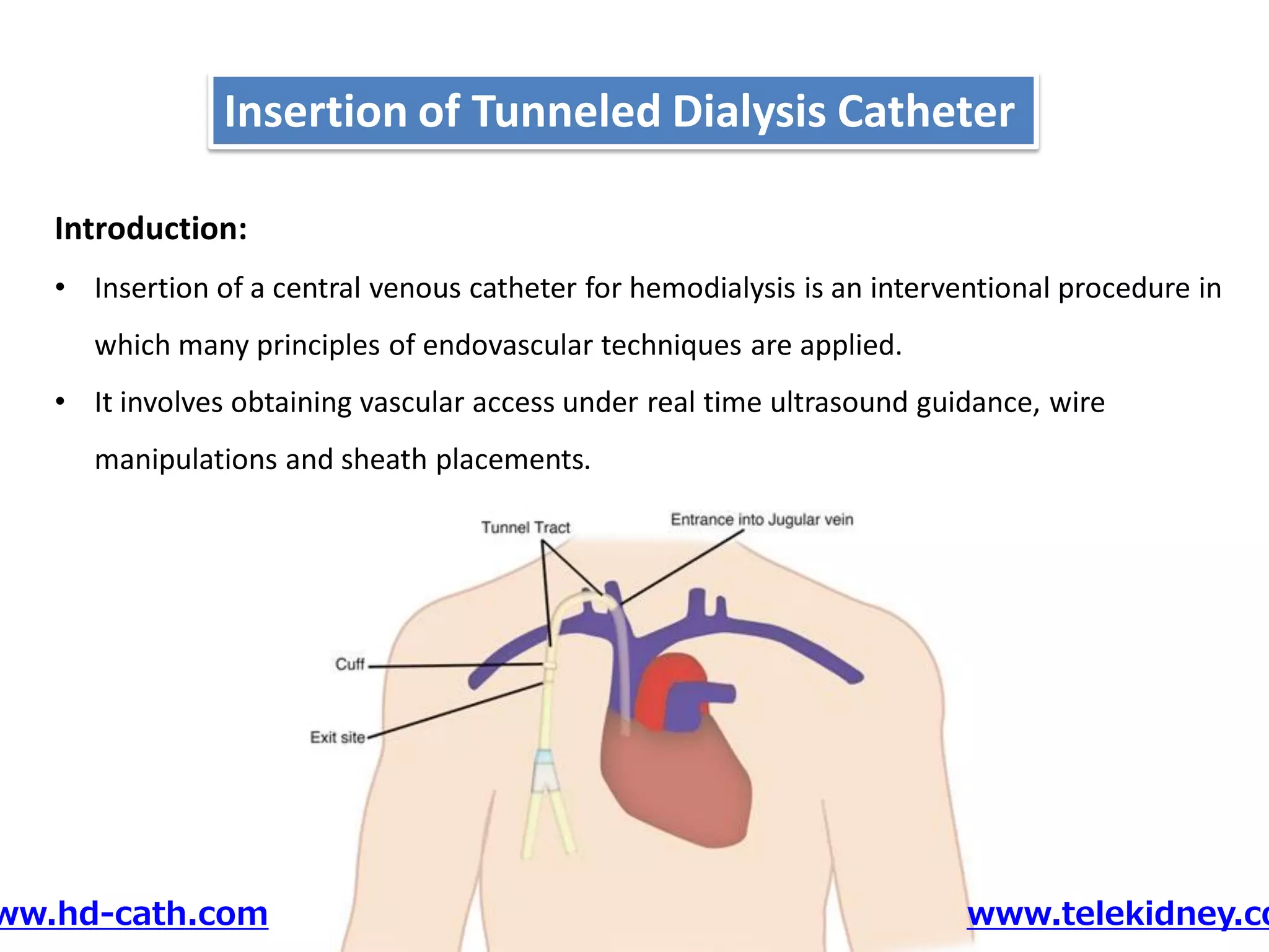 Tunneled catheter insertion | PDF