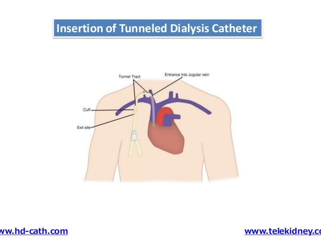 Quinton Line Insertion