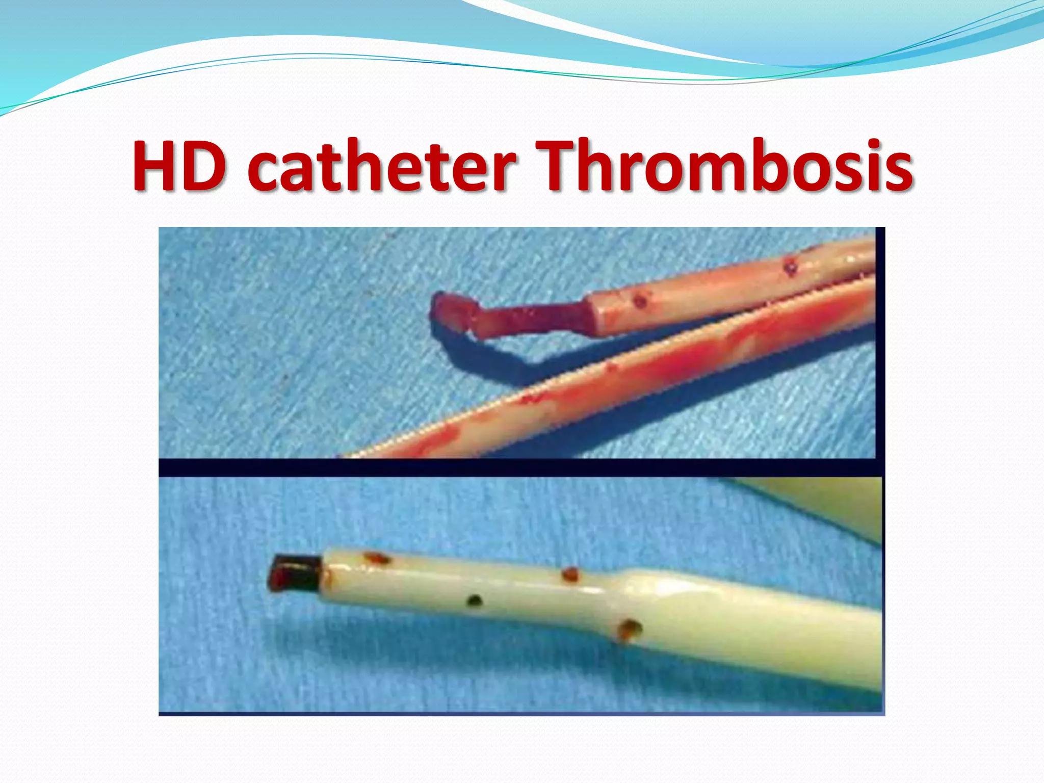 Tunnelled cuffed catheter (permacath) | PPTX