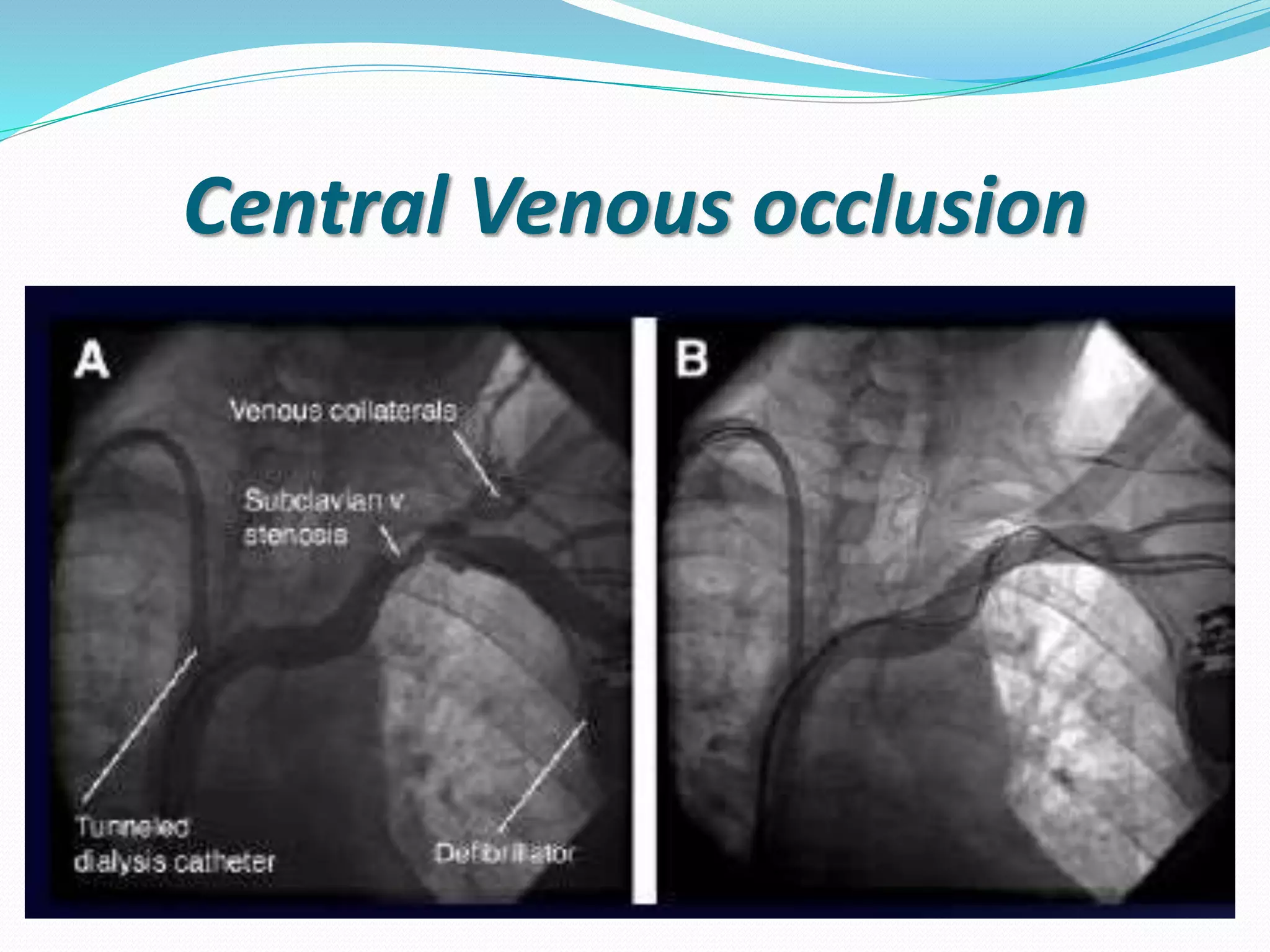 Tunnelled cuffed catheter (permacath) | PPTX