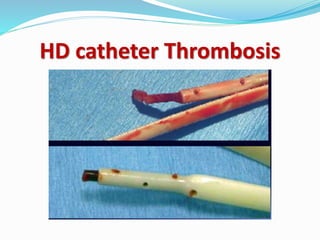 Tunnelled cuffed catheter (permacath) | PPTX