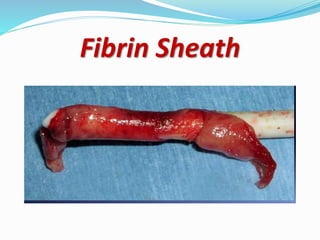 Tunnelled cuffed catheter (permacath) | PPTX