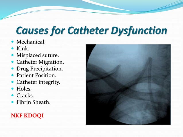 Tunnelled cuffed catheter (permacath) | PPTX