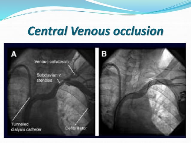 Tunnelled cuffed catheter (permacath) | PPTX
