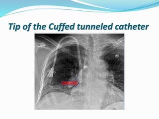 Tunnelled cuffed catheter (permacath) | PPTX
