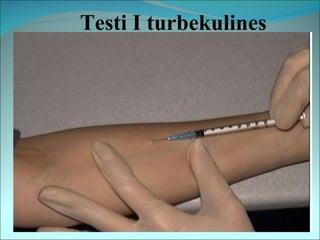 Tuberkulozi | PPS
