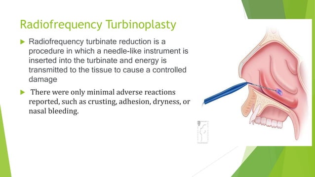 turbinate.pptx | Ear, Nose and Throat Conditions | Diseases and Conditions