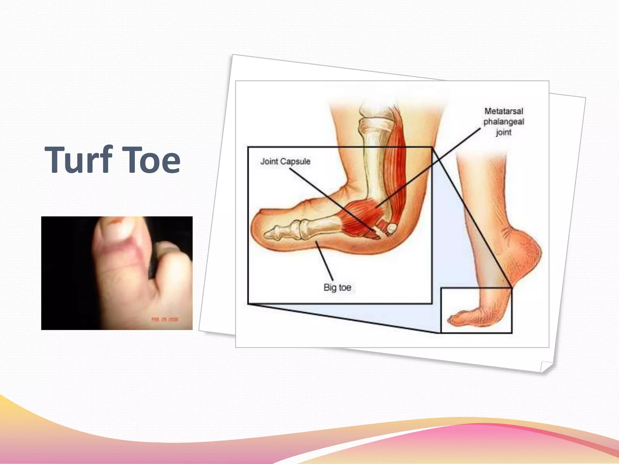 Project 1: Turf Toe | PPTX