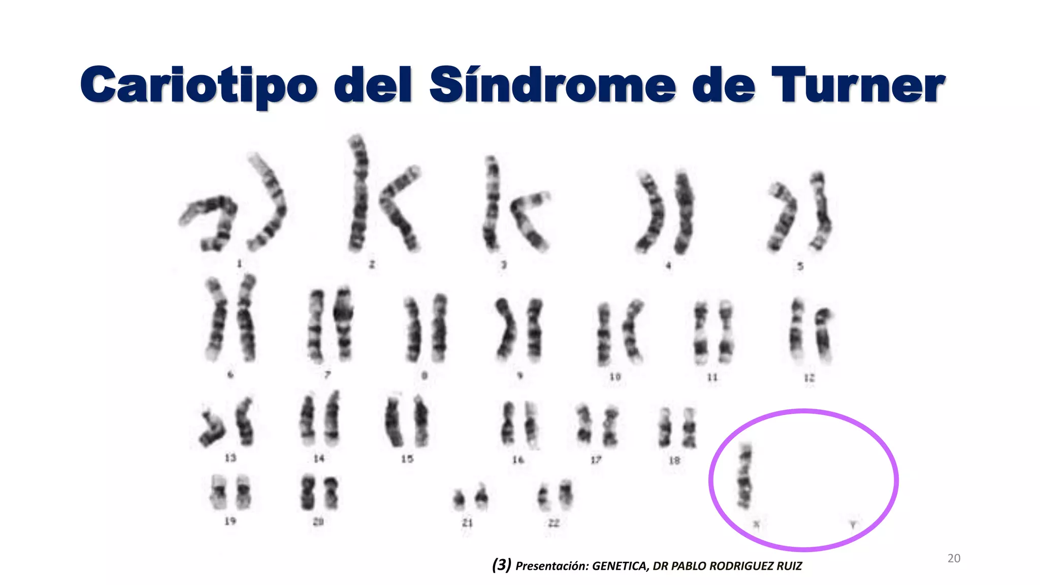Síndrome De Turner Ppt