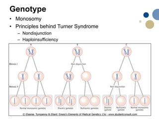 Turner syndrome presentation last | PPTX