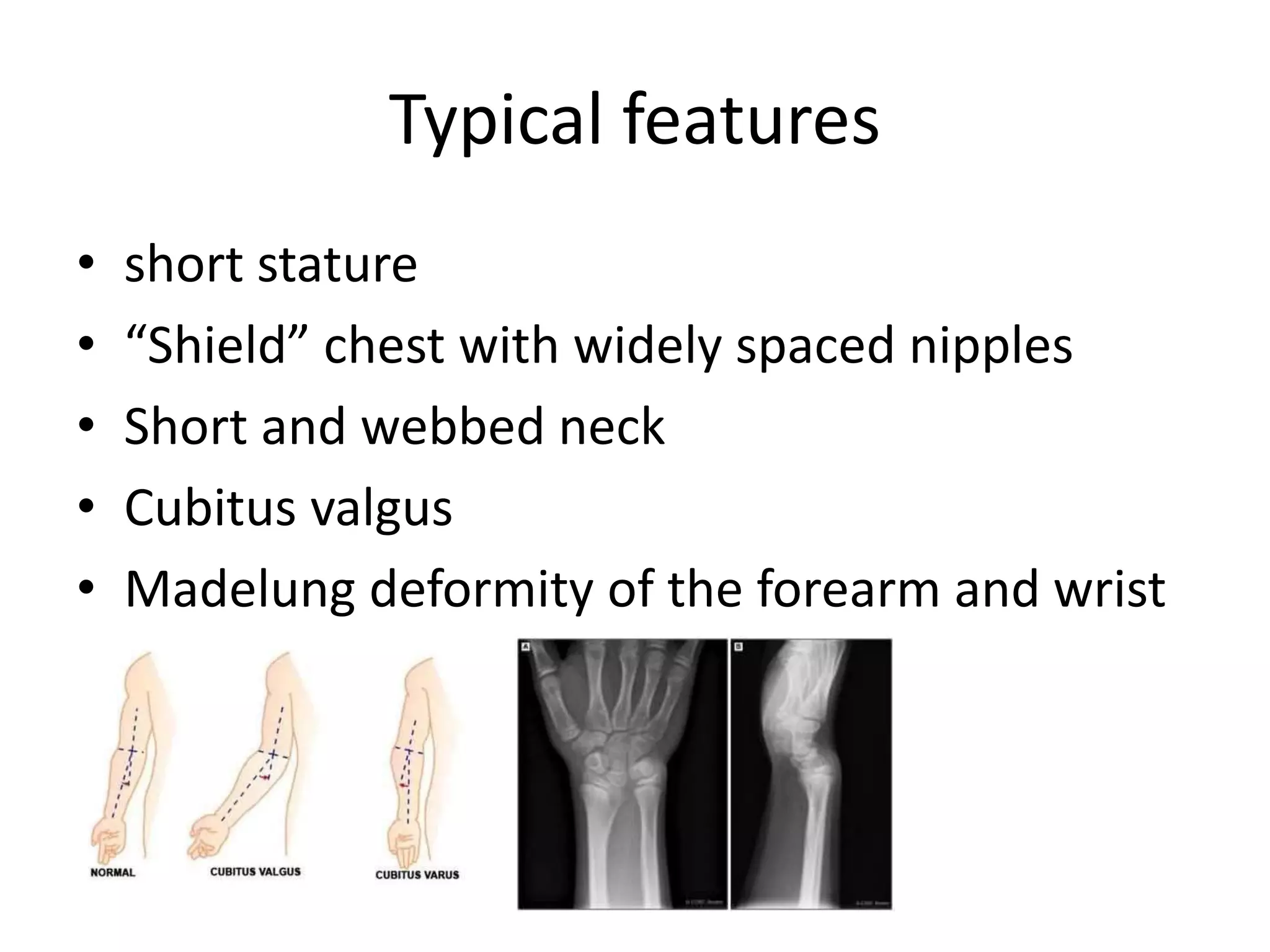 Turner syndrome | PPTX