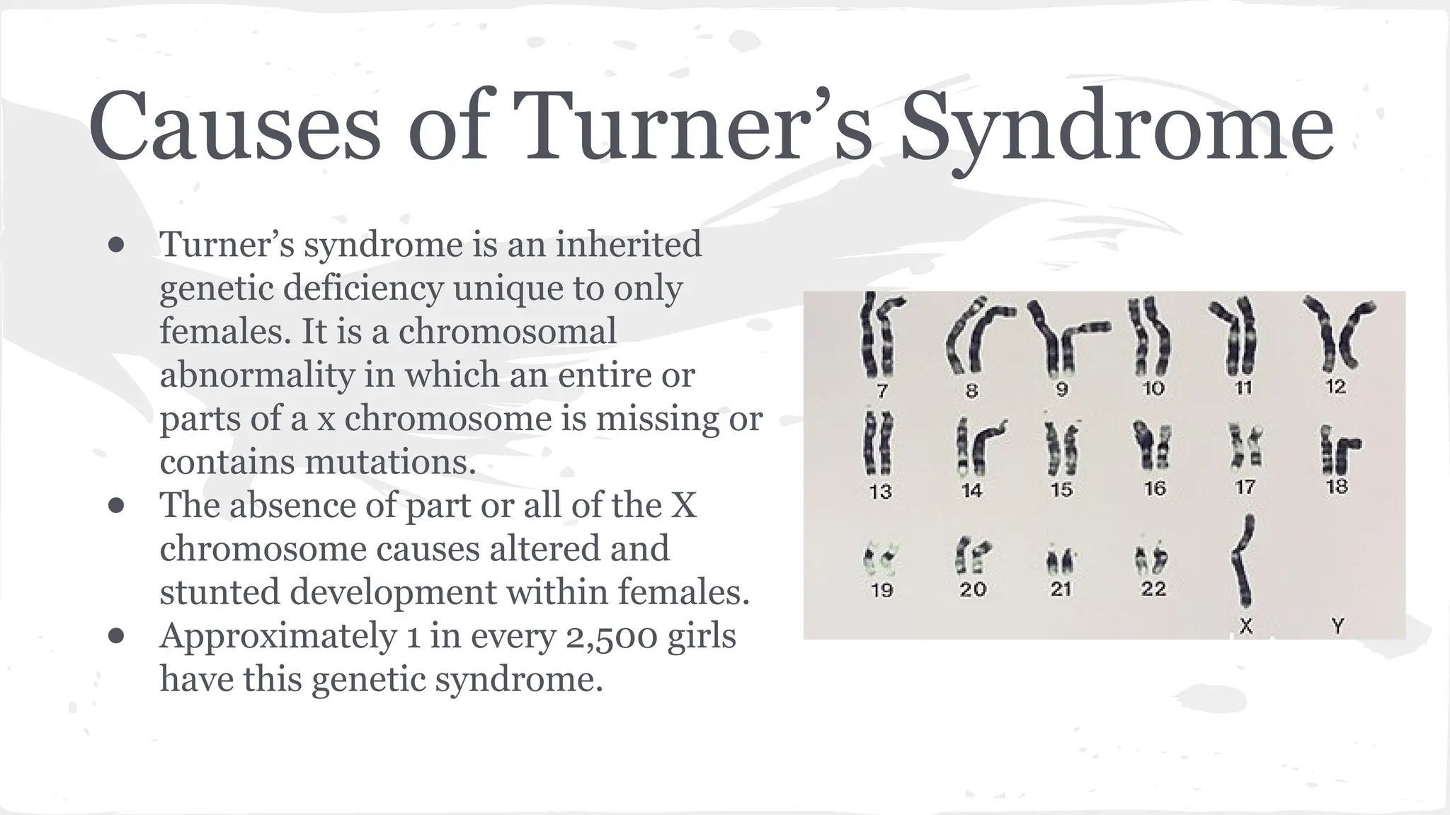 Turner's Syndrome .pptx