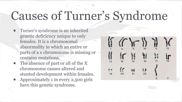 Turner's Syndrome .pptx