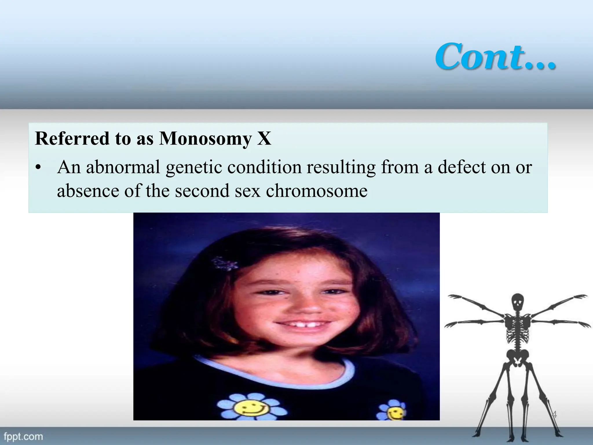 TURNER SYNDROM and causes any type sign symptoms | PPT