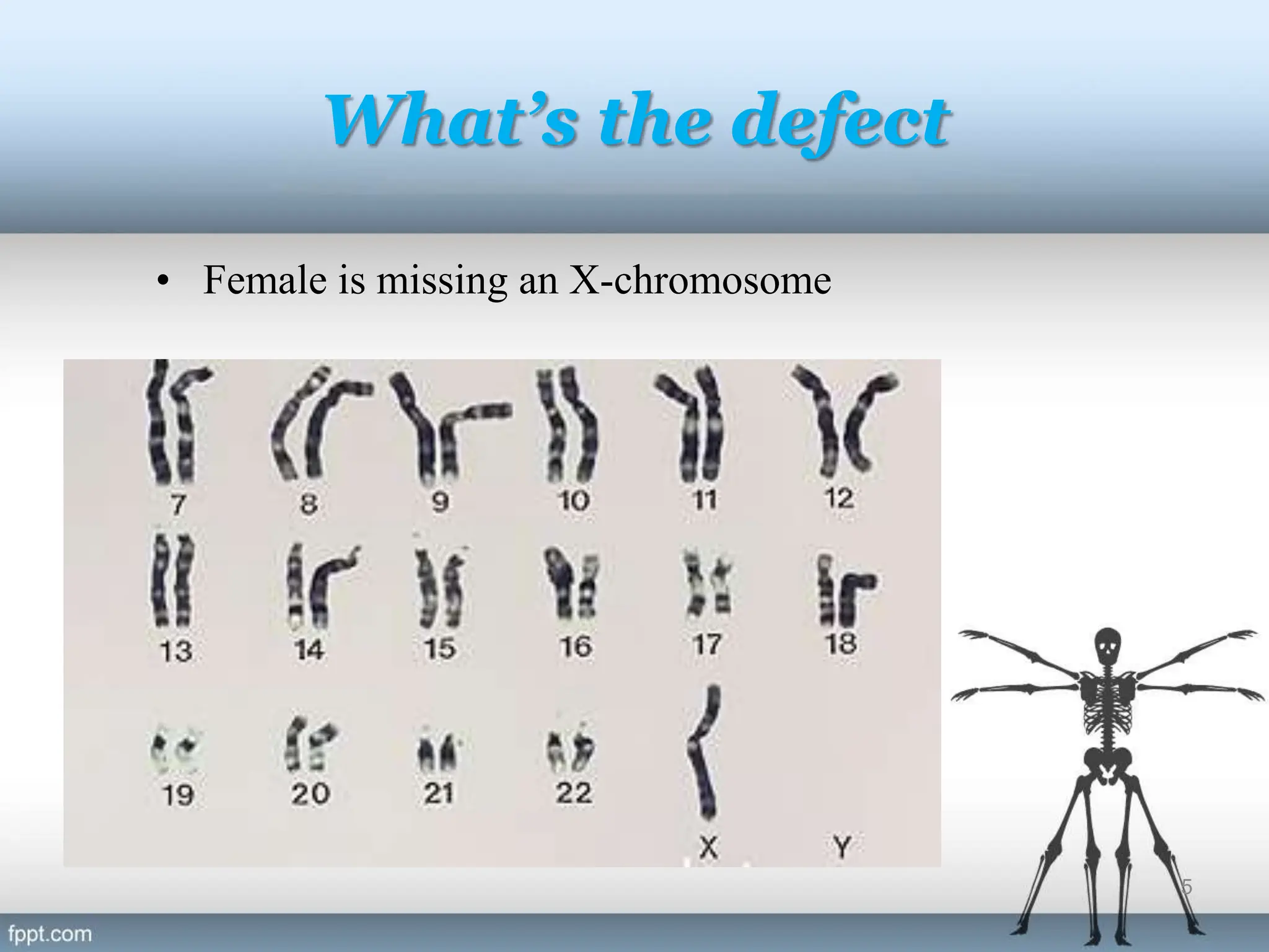 TURNER SYNDROM and causes any type sign symptoms | PPT