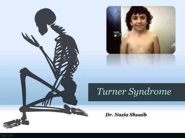 TURNER SYNDROM and causes any type sign symptoms | PPT