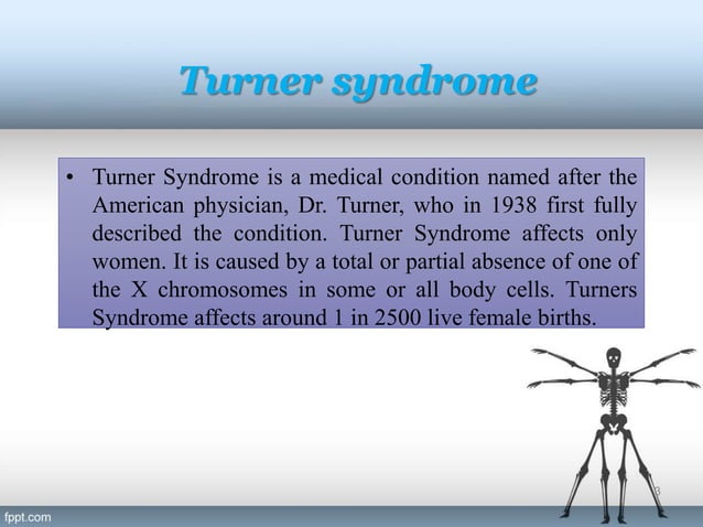 TURNER SYNDROM and causes any type sign symptoms | PPT