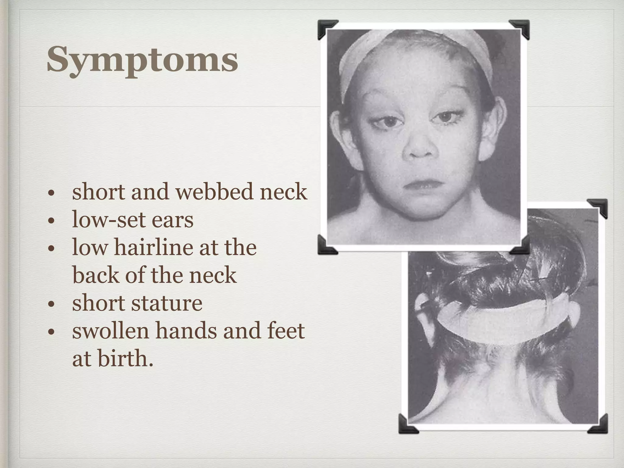 Turner syndrome | PPTX