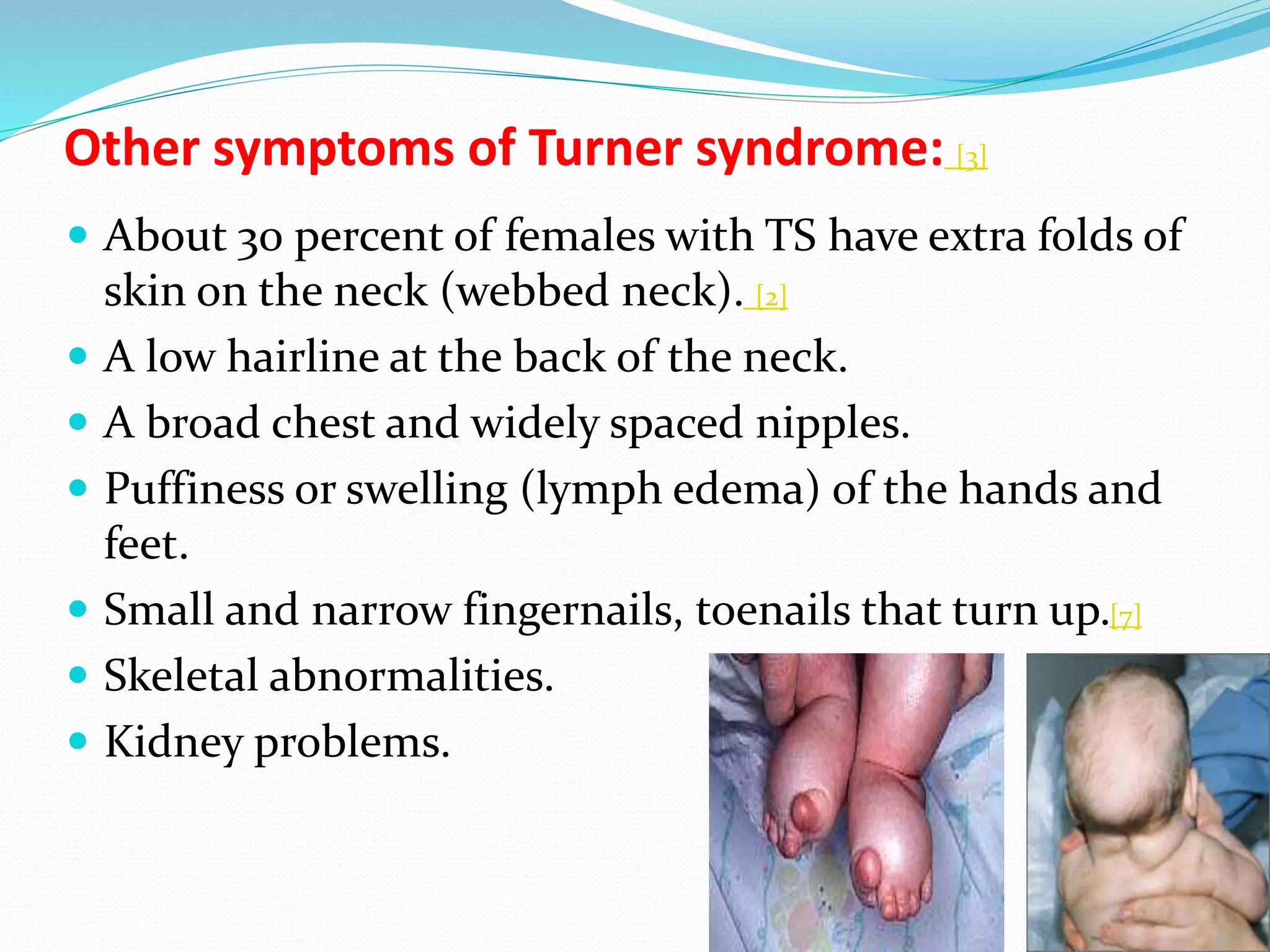 Turner syndrome | PPTX