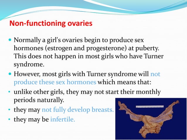 Turner Syndrome Ppt