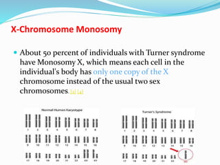 Monosomy Turner Syndrome