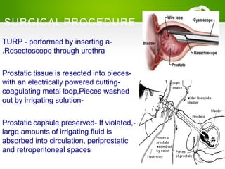 TURP 1-converted PPT FORMAT.pptx