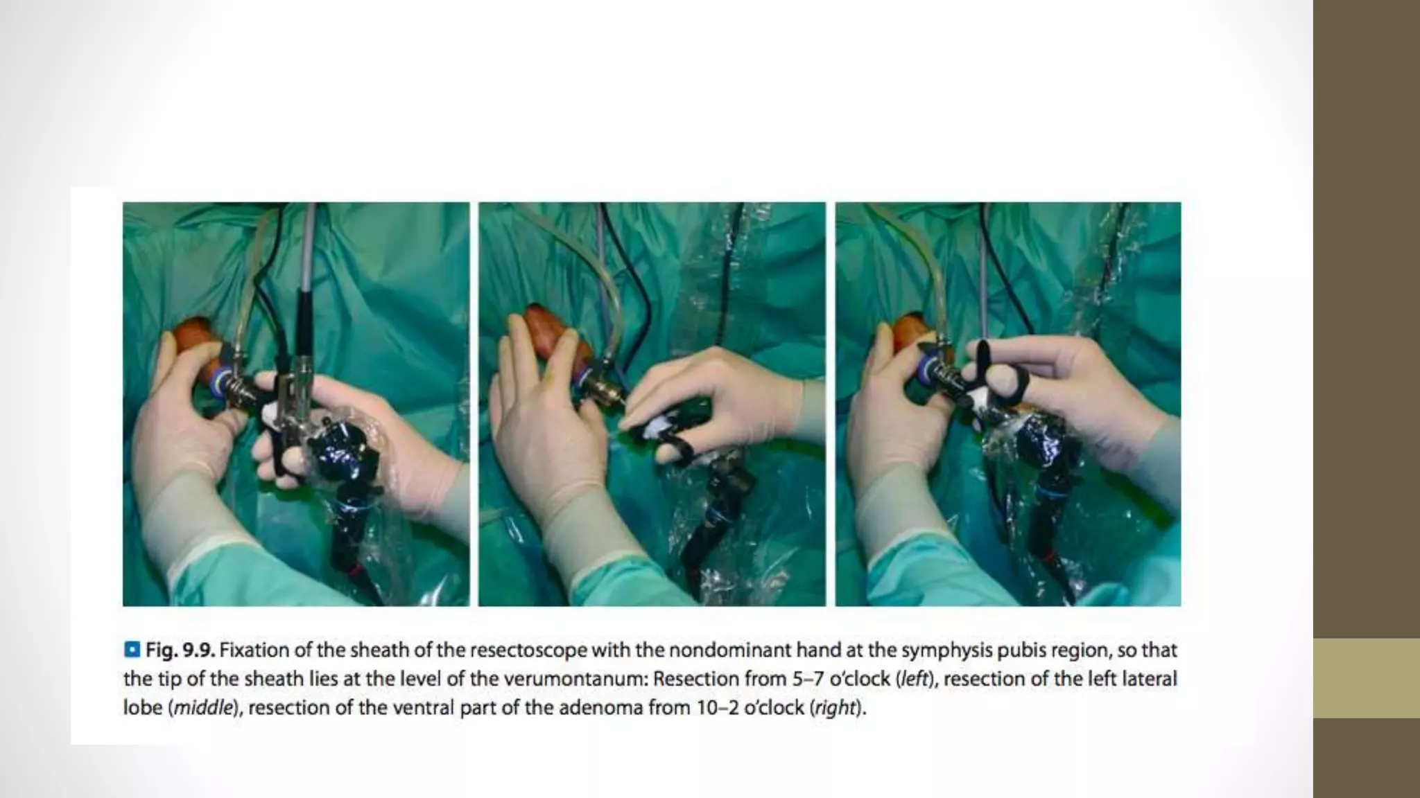 TURP TECHNIQUE | PPTX