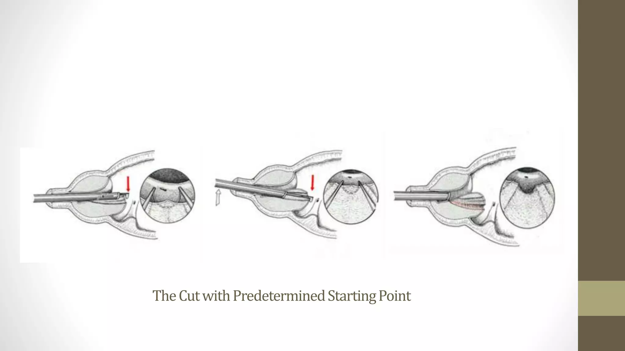 TURP TECHNIQUE | PPTX