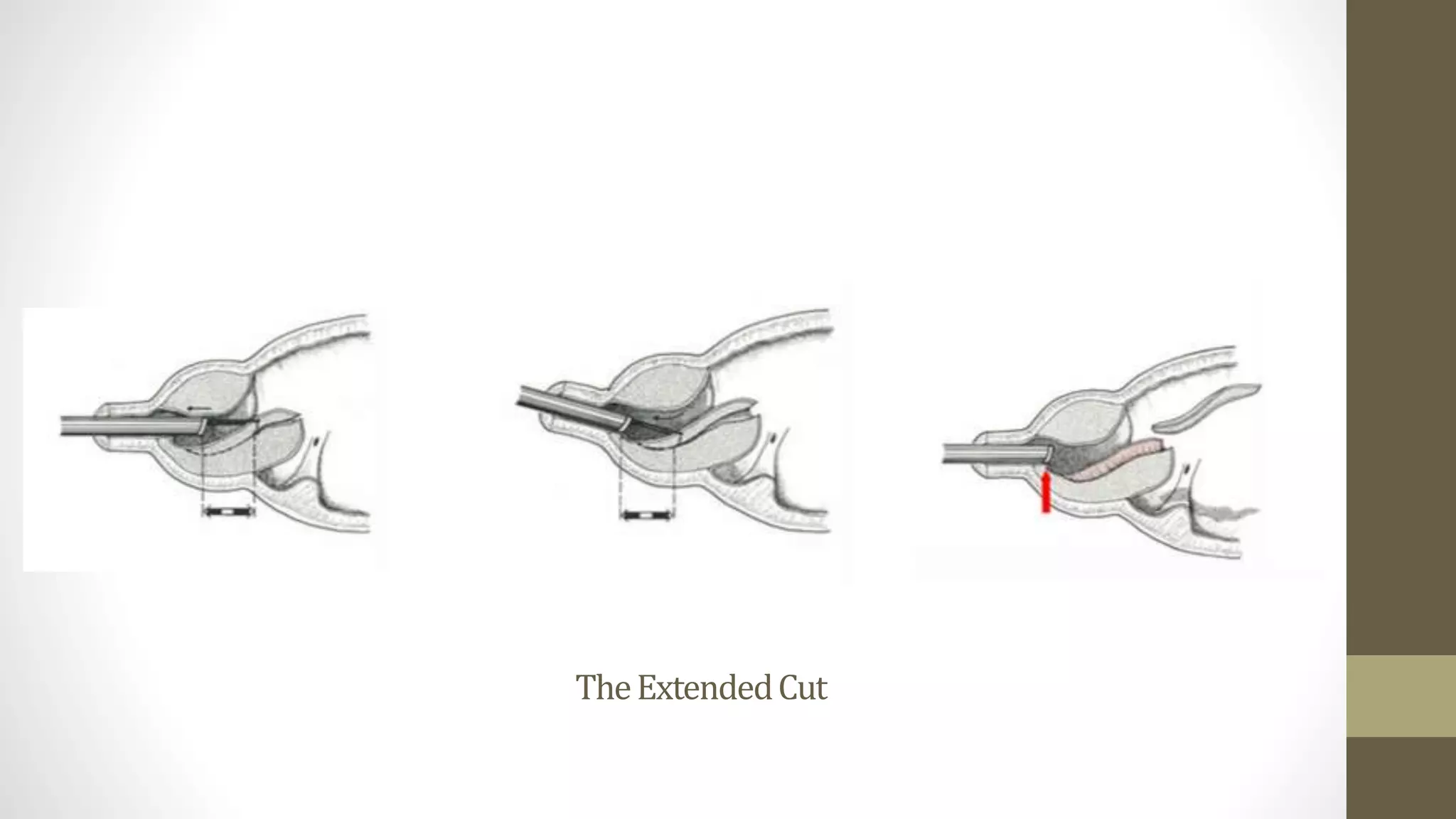 TURP TECHNIQUE | PPTX