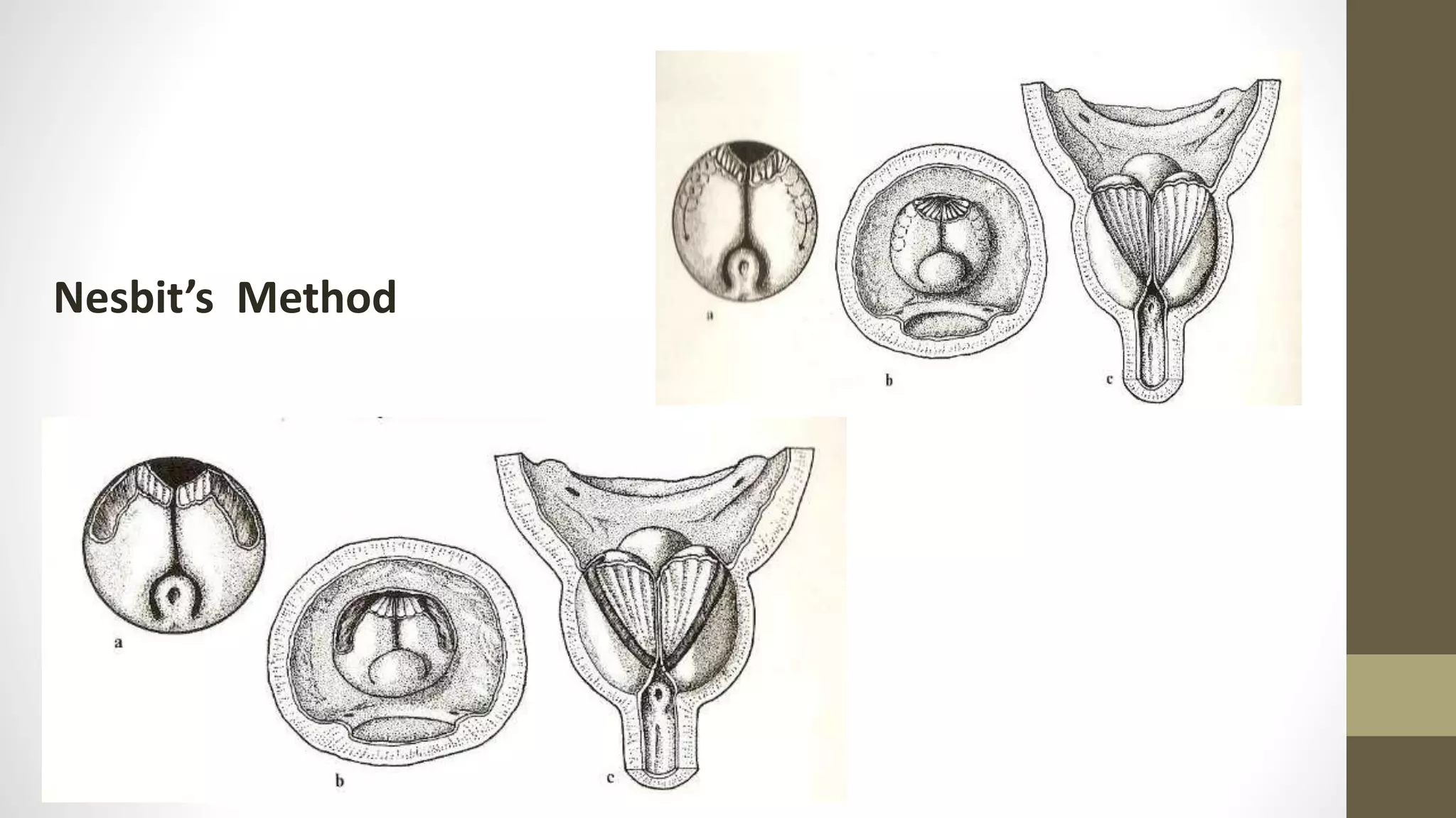 TURP TECHNIQUE | PPTX