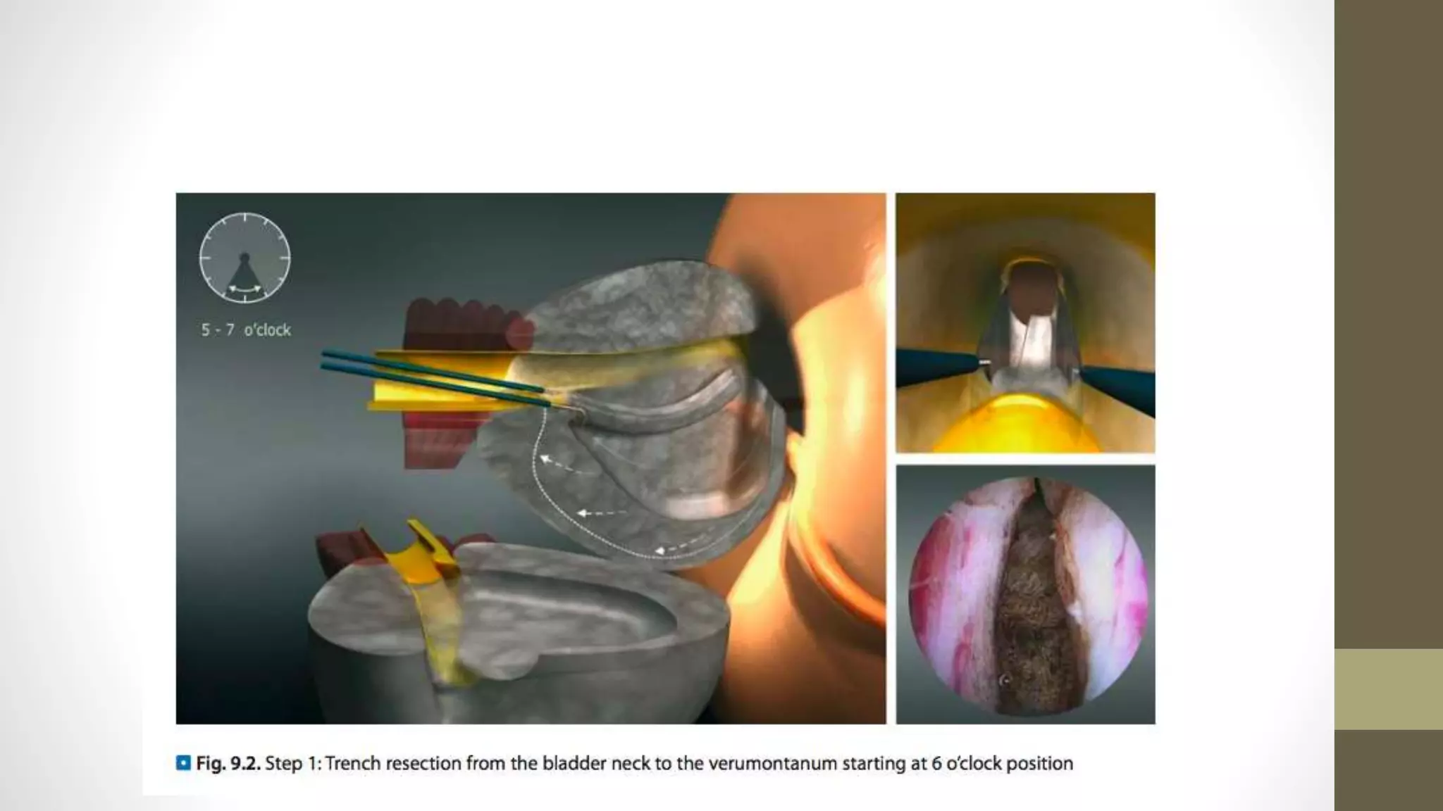 TURP TECHNIQUE | PPTX