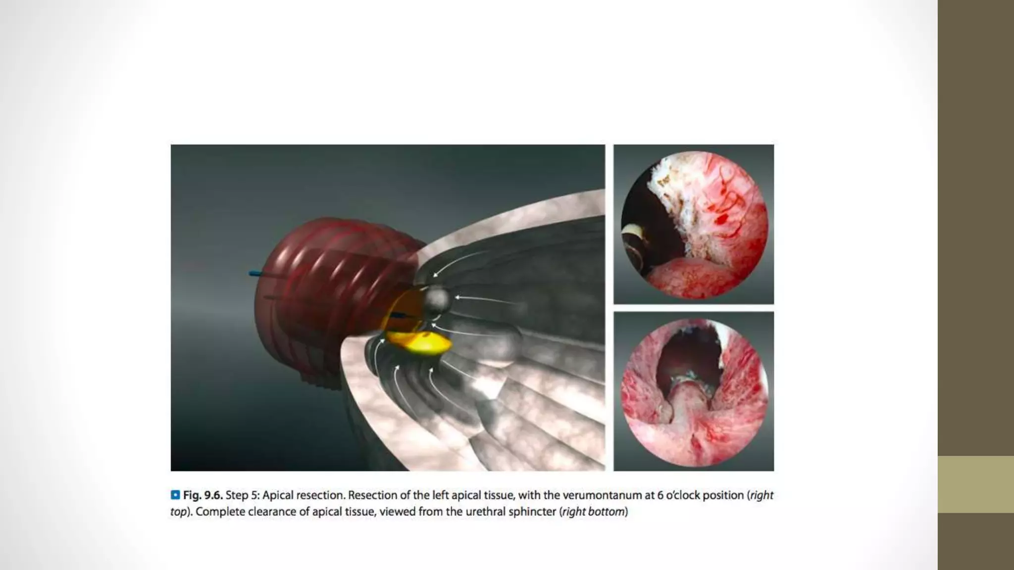 TURP TECHNIQUE | PPTX