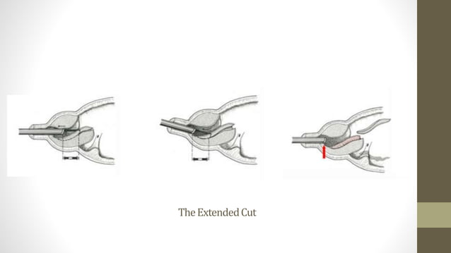 TURP TECHNIQUE | PPT