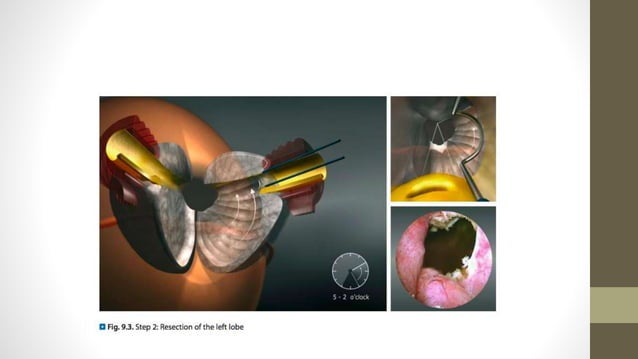 TURP TECHNIQUE | PPTX | Digestive Disorders | Diseases and Conditions