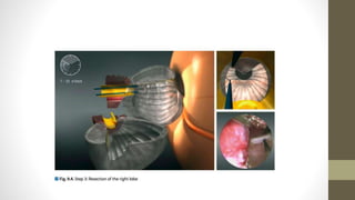 TURP TECHNIQUE | PPT