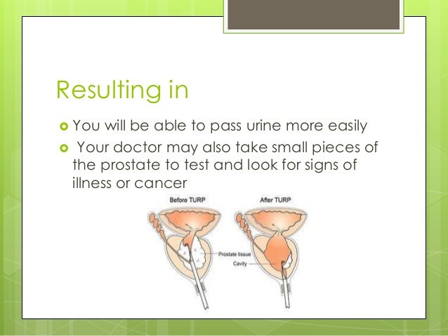 TURP Presentation