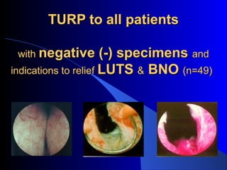 Resection of the prostate | PPT