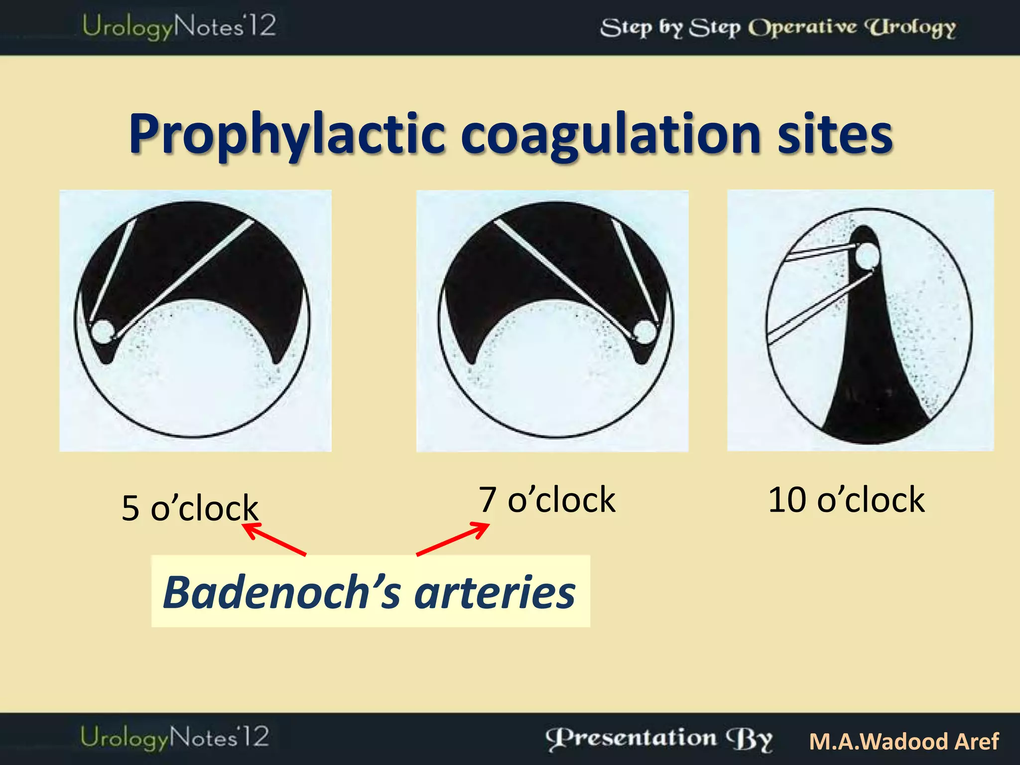 TURP step by step operative urology | PDF