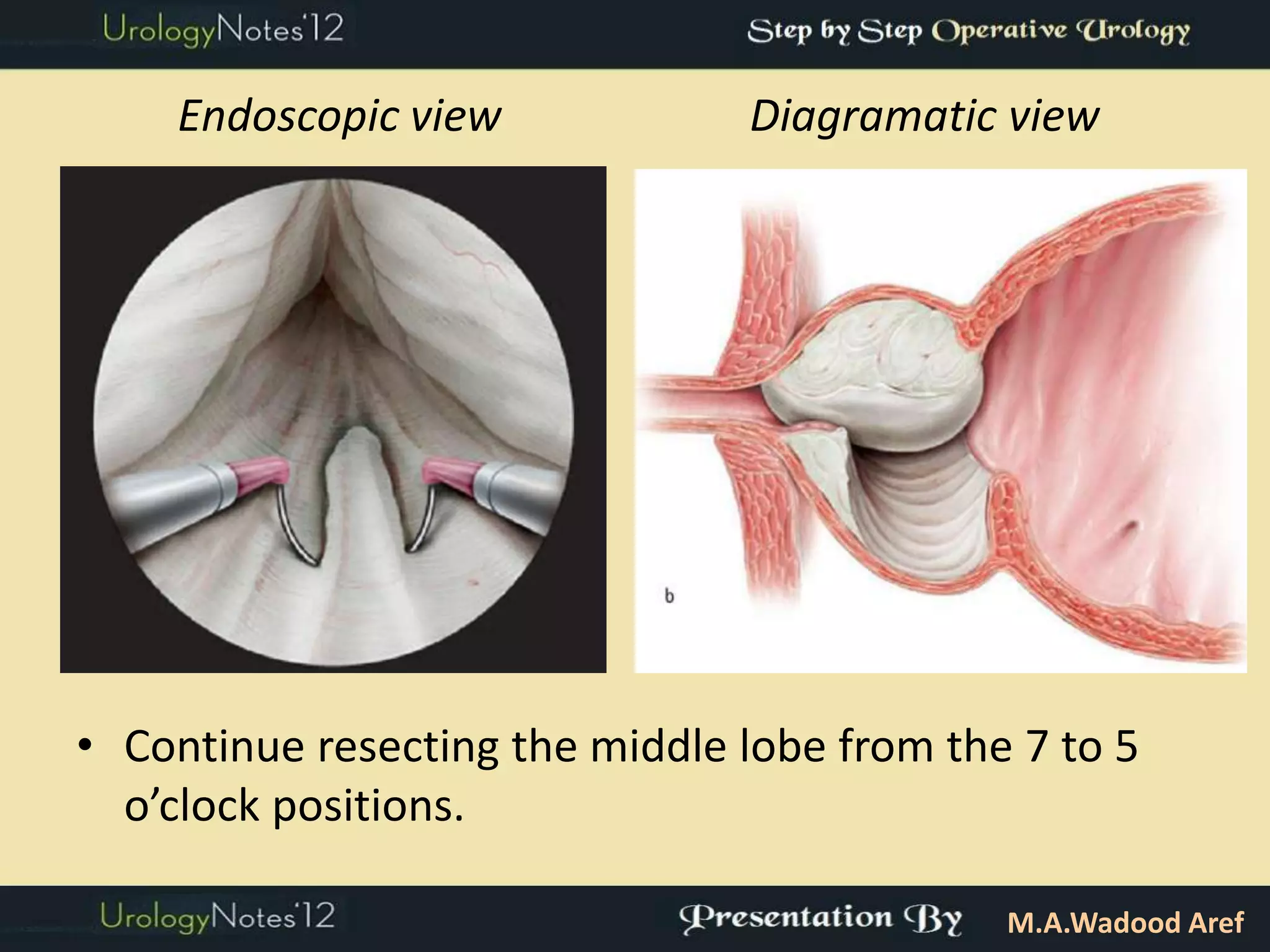 TURP step by step operative urology | PDF