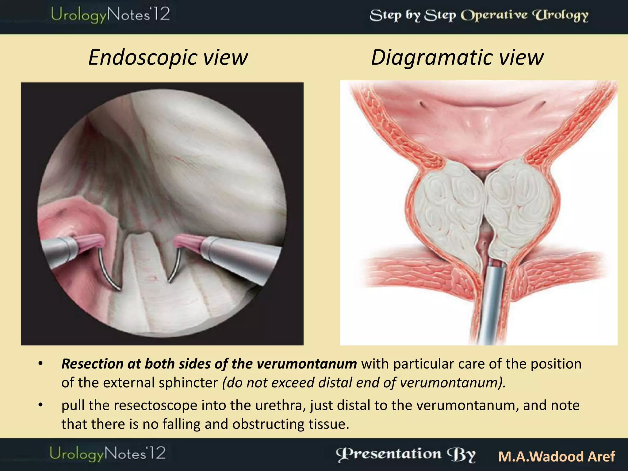 TURP step by step operative urology | PDF