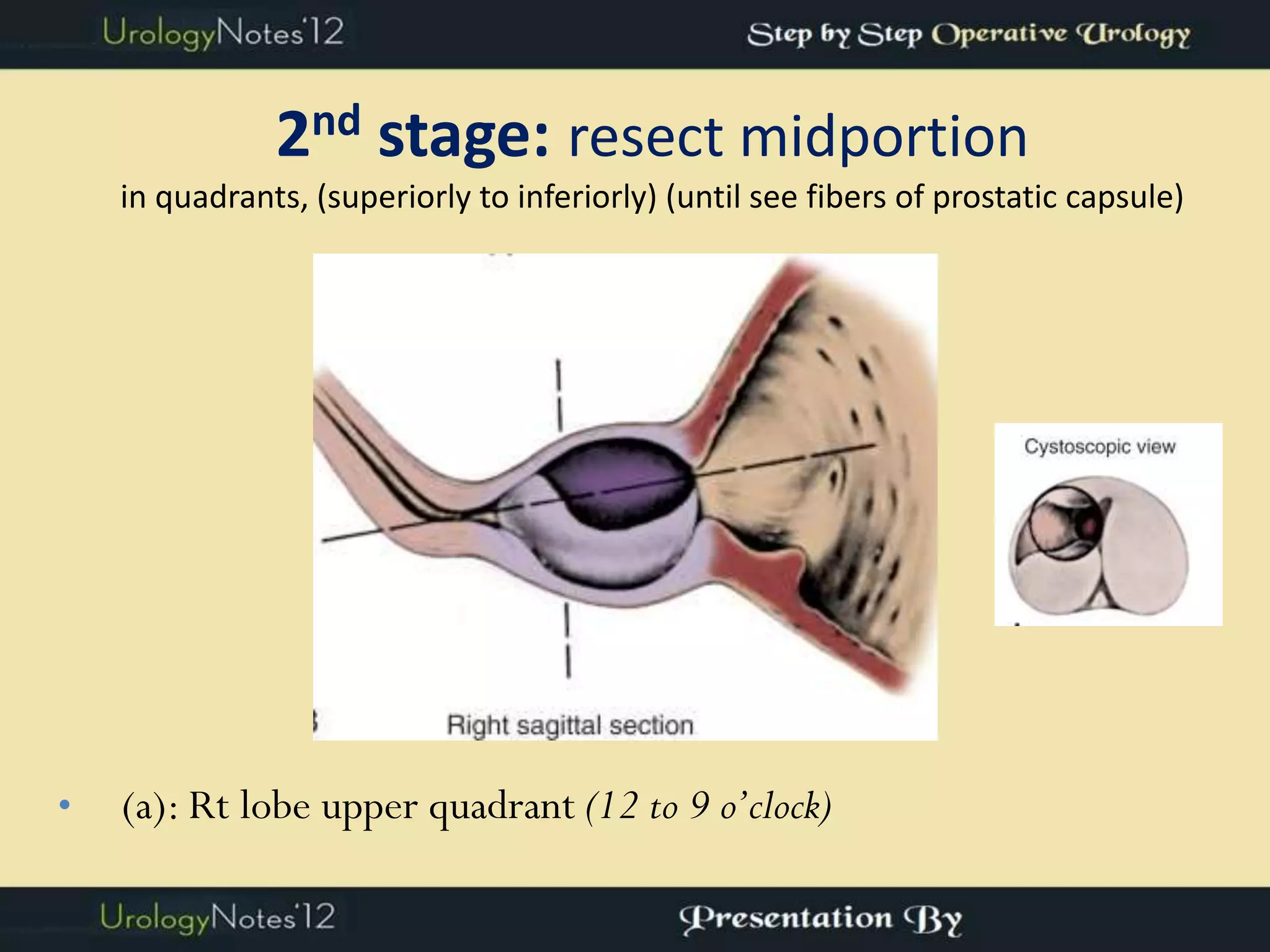 TURP step by step operative urology | PDF