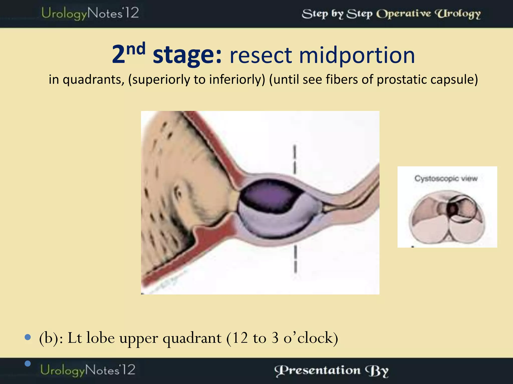 TURP step by step operative urology | PDF