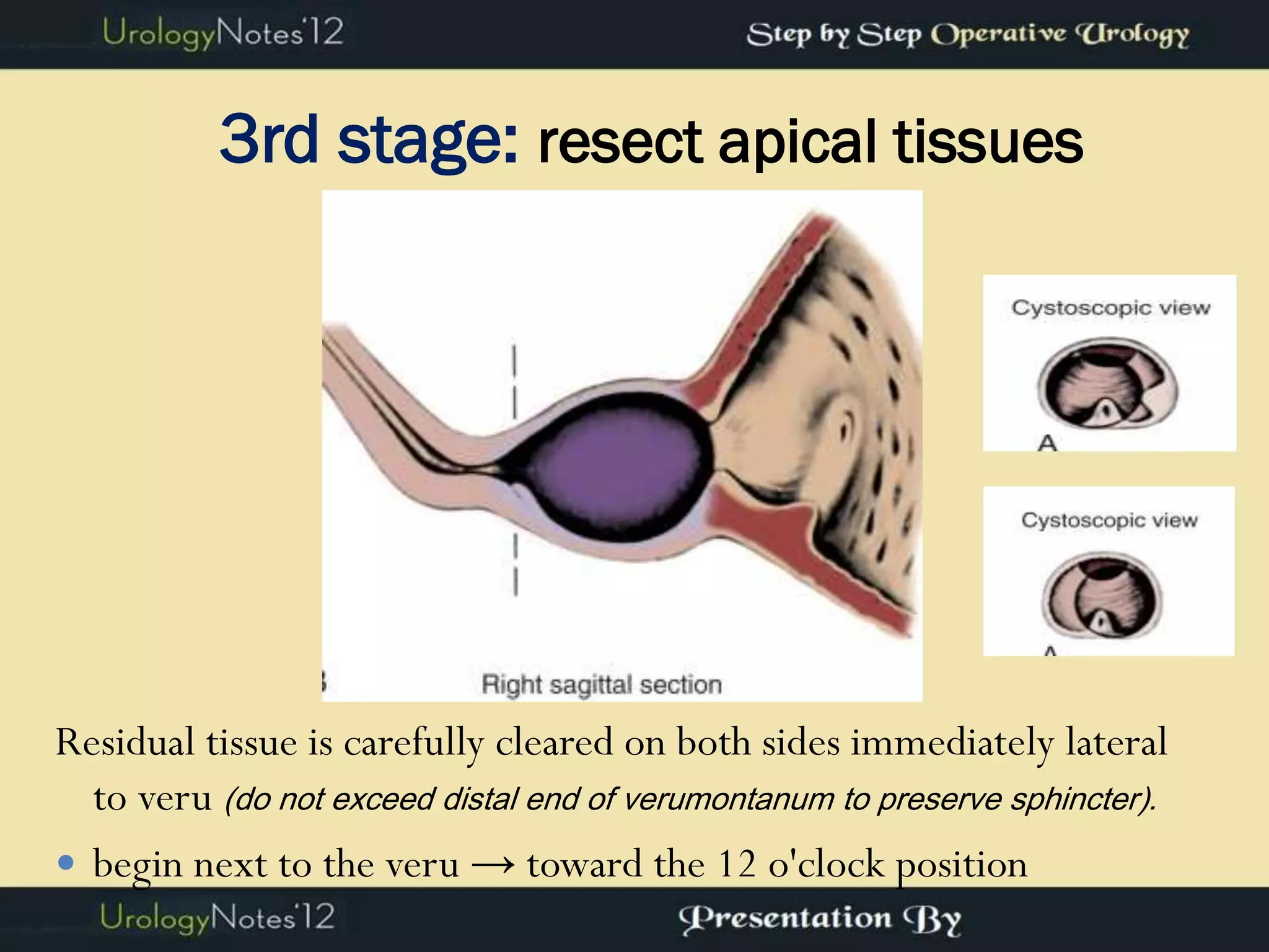 TURP step by step operative urology | PDF